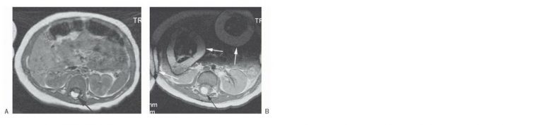 Aliasing artifact | MRI FARSI
