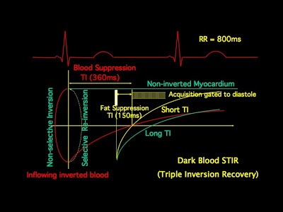 (DIR (Double inversion recovery | MRI FARSI