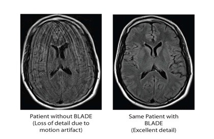 BLADE (PROPELLER) | MRI FARSI