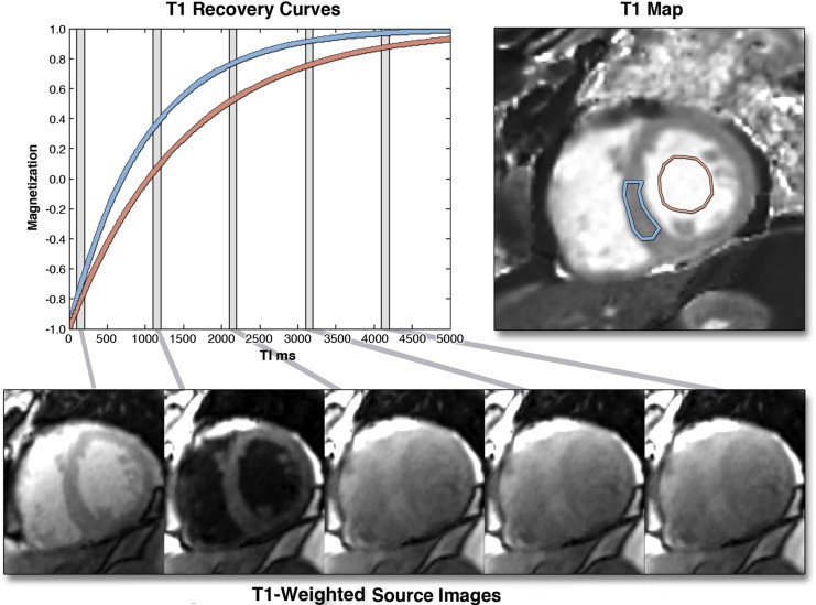 Myocardial T1-mapping | MRI FARSI